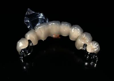China Durable Porcelain Fused To Metal Crown Dental Restoration Solution Ideal For Long Lasting Strength And Natural Appearance for sale