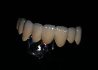 China Durable Porcelain Fused To Metal Crown Dental Restoration Solution Ideal For Long Lasting Strength And Natural Appearance for sale