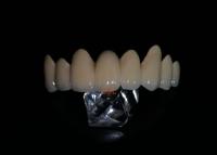 China Durable Porcelain Fused To Metal Crown Dental Restoration Solution Ideal For Long Lasting Strength And Natural Appearance for sale