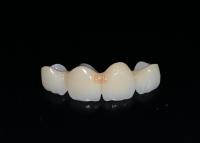 China Innovative zirconia bridge teeth designed to combine strength and natural aesthetics for durable dental bridge solutions for sale