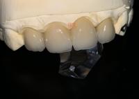 China Innovative zirconia bridge teeth designed to combine strength and natural aesthetics for durable dental bridge solutions for sale