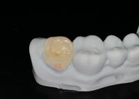 China Innovative Ceramic Dental Prosthetics Featuring Accurate Margins and Enhanced Wear Resistance for Dental Professionals for sale