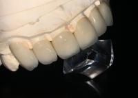 China Lightweight Ceramic Dental Prosthesis Providing Excellent Wear Resistance and Natural Look Perfect for Dental Specialists for sale