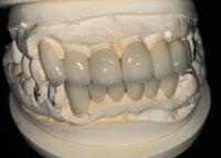 China Lightweight Ceramic Dental Prosthesis Providing Excellent Wear Resistance and Natural Look Perfect for Dental Specialists for sale