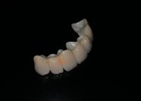 China Durable Ceramic Dental Prosthetics Customized Solutions for Long Lasting Restorations in Dental Clinics and Laboratories for sale