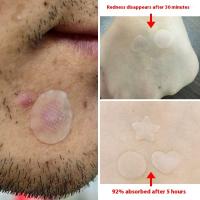 China Single Sided Painless Microneedle Acne Patch Microcrystals Water Activated PE Adhesive Sticker 0.25mm Thickness for Masking Use for sale
