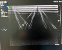 China EPIQ 5 Ultrasound Machine Repair All Probe Images Are Abnormal Replace ACQ for sale