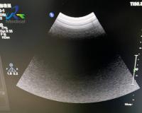 China EPIQ 5 Ultrasound Machine Repair All Probe Images Are Abnormal Replace ACQ for sale