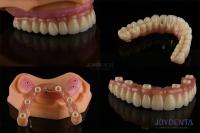 China Ivoclar Implant Ball Attachments Removable Dental Implant Material For Oral Hygiene for sale