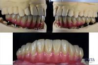 China Dental Reconstruction Multiple Teeth Implant Titanium Prosthetic Connection Internal for sale