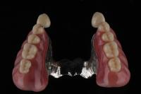 China Stain Odor Resistant Full Acrylic Denture Natural Looking Acrylic Resin Denture Teeth for sale