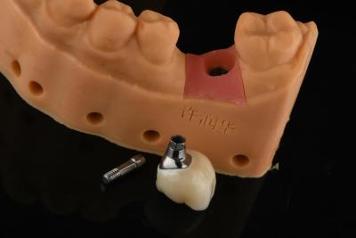 China Precision Cylindrical Silver Single Tooth Replacement Implants Dental Restoration for sale