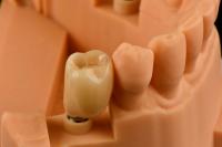 China Internal Hex Connection Sandblasted Titanium Dental Implants Single Tooth Replacement for sale