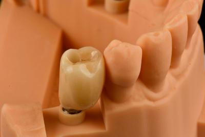 China Internal Hex Connection Sandblasted Titanium Dental Implants Single Tooth Replacement for sale