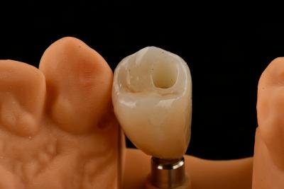 China Titanium Single Tooth Dental Implants Internal Hex Connection Type For Optimal Fit for sale