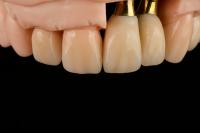 China Titanium Sandblasted Single Tooth Replacement Implant With Gamma Irradiation Sterilization for sale