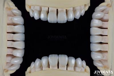 China Ceramic For Natural Aesthetics Dental Veneers Stain Resistance Maintains Brightness Strong Bond With Tooth Enamel For Secure Fit for sale