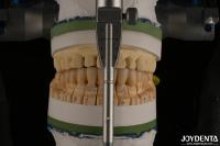 China High Aesthetics Porcelain Layered Dental Zirconia For Implant Restorations for sale