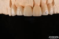 China CAD / CAM Milling Dental Layered Zirconia For Single Crowns 0.3-0.5mm Layer Thickness for sale