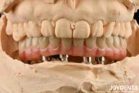China Aesthetic Titanium Malong Hybrid Dental Implant Bridge For Dental Perfection for sale