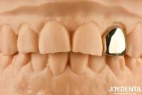 China Gold 60K Metallic Oral Crown Abrasion Resistant Dental Crown Wax Casting for sale