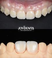 China Lightweight Smooth Surface Zirconia Dental Bridges For Implant Supported Restorations for sale