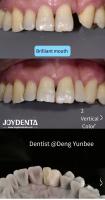 China Resin Bonded Maryland Bridge Posterior Teeth for Regular Brushing Flossing for sale