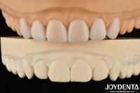 China Lightweight Property Flexible Denture Finish Personalized Customization For Diverse Specifications for sale