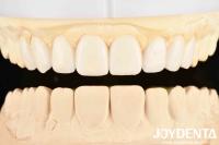 China Dental's Good Elasticity And Tooth Arrangement Technology Flexible Denture Finish In Dental Care for sale