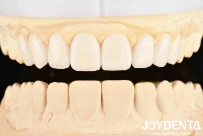 China Dental's Good Elasticity And Tooth Arrangement Technology Flexible Denture Finish In Dental Care for sale