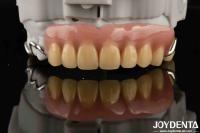 China Elaborate Dental Stable Oral Structure  Framework Set Up Teeth Finish For Optimal Oral Health for sale