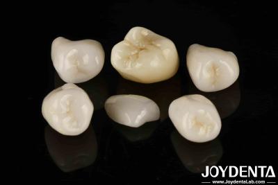 China Easy Cementation Emax Inlay Onlay Medium Strength Natural-looking Esthetics for sale