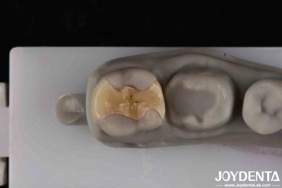 China Low Translucency Inlay Onlay Secure Cementation For Long-Lasting And Aesthetic Restorations for sale