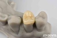China Secure Cementation Emax Inlay Onlay Easy To Clean And Resistant To Staining for sale