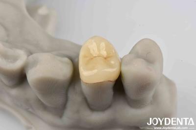 China Secure Cementation Emax Inlay Onlay Easy To Clean And Resistant To Staining for sale