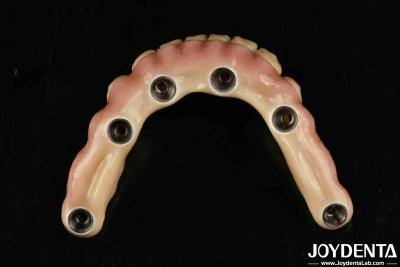China Durable Dental Aesthetic Titanium Malong Hybrid Bridge For Care for sale