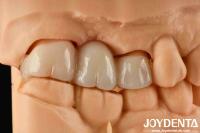 China Experience Color Realistic Full Zirconia With High Resistance To Staining And Flexural Strength Of 1000 MPa for sale