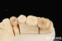 China Excellent Biocompatibility Full Zirconia With High Resistance To Corrosion And Flexural Strength Of 1000 MPa for sale