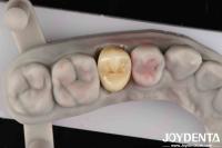 China Fracture Toughness 9 MPa·m1/2 High Aesthetics High Resistance To Wear Full Zirconia for sale