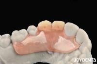 China Beautiful And Harmonious Appearance Design Framework Set Up Teeth Finish Elaborate Technology For Stable Oral Structure for sale