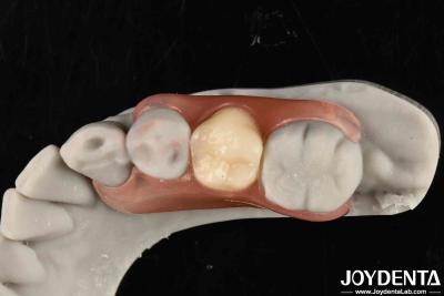 China Revolutionize Your Dental Practice  Framework Set Up Teeth Finish With Elaborate Technology From Dental for sale