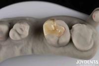 China Strong Resistance To Fracture Emax Inlay Onlay Natural-looking Esthetics And Durability for sale