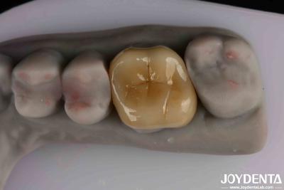 China Easy To Clean And Durable Emax Inlay Onlay Resistance To Staining For Optimal Performance for sale