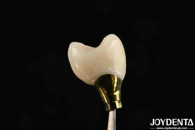 China Various Sizes Implant Crown And Bridge For Strong Dental Implants Compatibility for sale