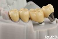 China Natural-looking Implant Crown And Bridge Safe For Oral Long Lasting Performance for sale