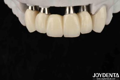 China Customizable Implant Crown And Bridge For Safe Oral Biocompatibility for sale