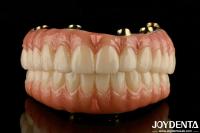 China Natural Teeth And Gums Compatible Ti-Bar Zirconia Hybrid Bridge With High Biocompatibility for sale
