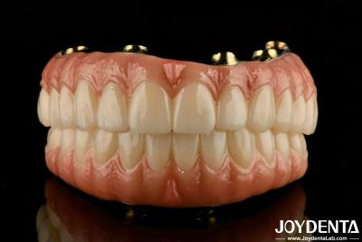 China Natural Teeth And Gums Compatible Ti-Bar Zirconia Hybrid Bridge With High Biocompatibility for sale