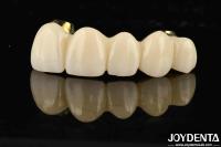 China Excellent Strength Ti-Bar Zirconia Hybrid Bridge For Natural Teeth And Gums Compatibility for sale