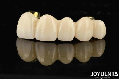 China Excellent Strength Ti-Bar Zirconia Hybrid Bridge For Natural Teeth And Gums Compatibility for sale